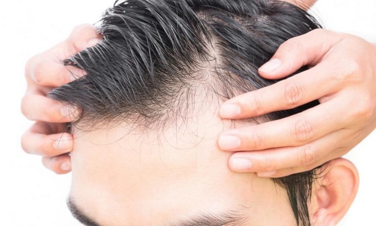 Hair Thinning In Men: Everything You Need To Know - AtoZ Hairstyles